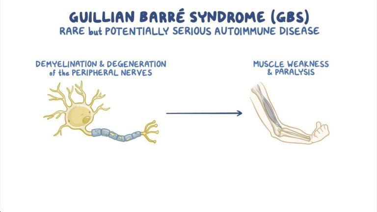 क्या है Guillain-Barre Syndrome? जिसकी वजह से पेरू में लगाई गई है हेल्थ ...